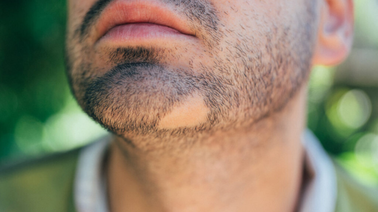 Pelade barbe ou trou barbe : causes, traitements et repousse capillaire