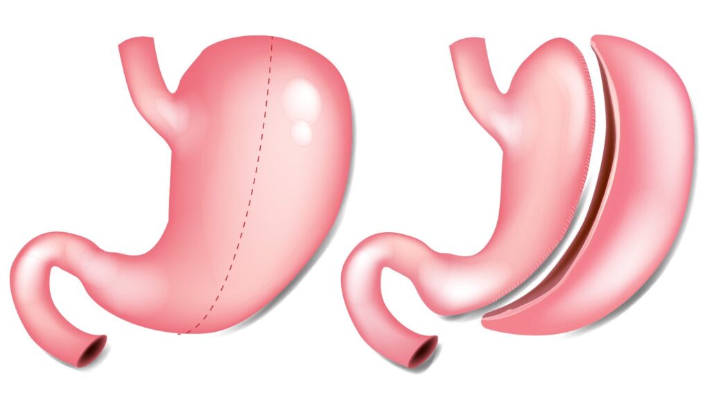 Gastric Bypass in Cardiff vs. Diyarbakır - Detailed Comparison.